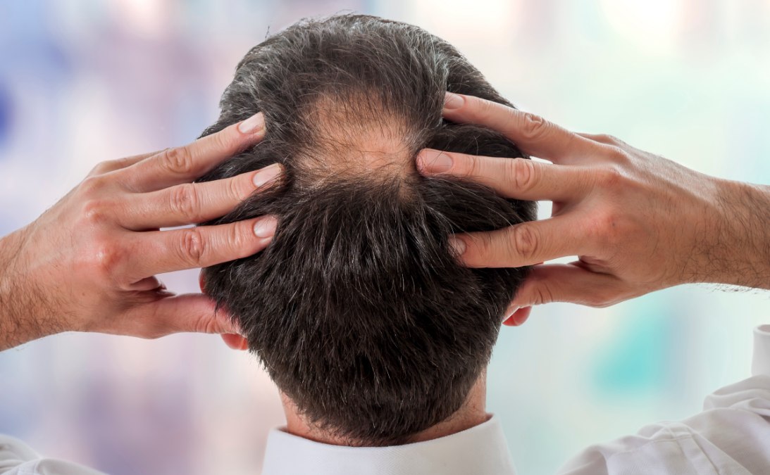 Bald Spot Concealers To Color The Scalp And Make A Bald Spot Less Bald Spot Concealers To Color The Scalp And Make A Bald Spot Less