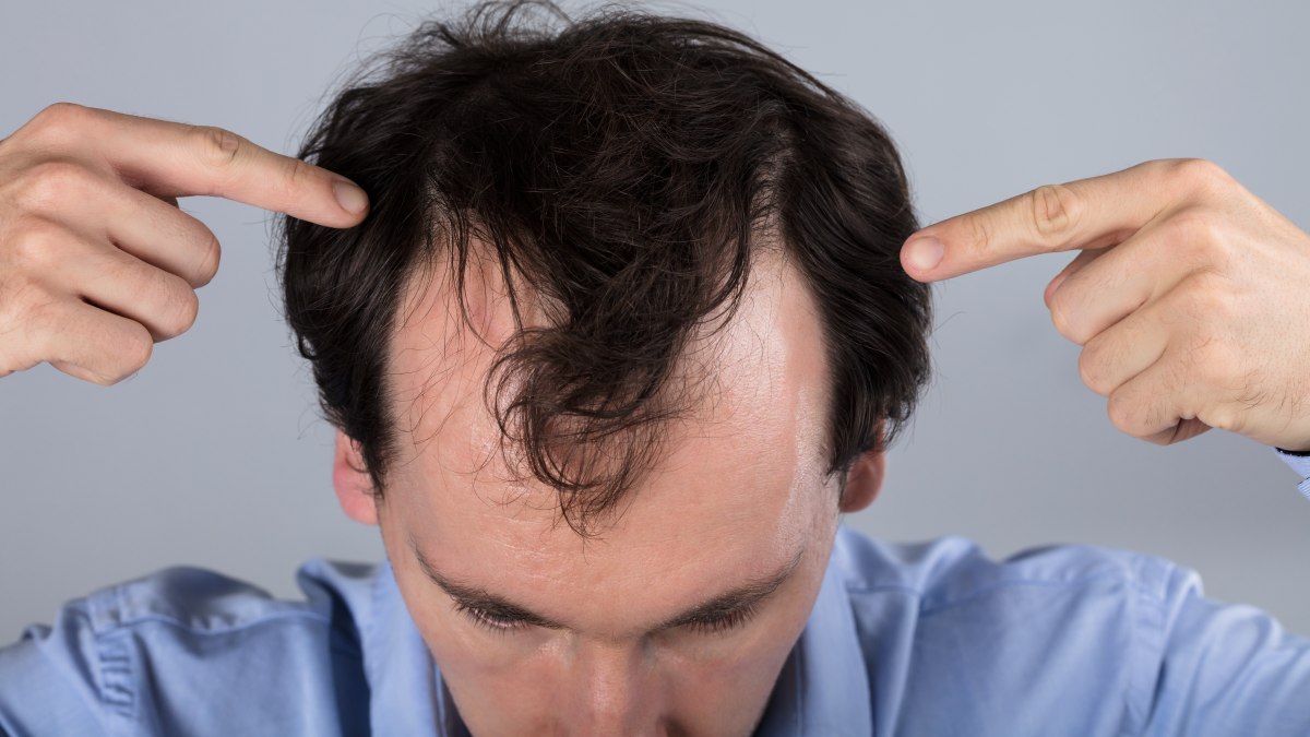 Wie man mit Haarausfall umgehen kann | Dünner werdendes Haar kaschieren